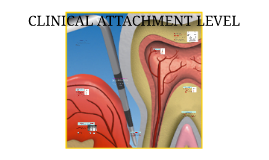Clinical Attachment Level by Paulette Lamothe on Prezi