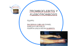 FLEBOTROMBOSIS by Rodolfo Alquicira on Prezi