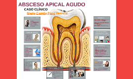 ABSCESO APICAL AGUDO by camila paez on Prezi