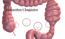 Megacolon Chagásico by Victor Hugo Bueno Silva on Prezi
