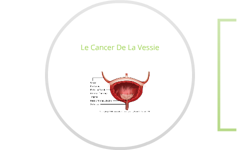 Le Cancer De La Vessie by Nicole Baker on Prezi