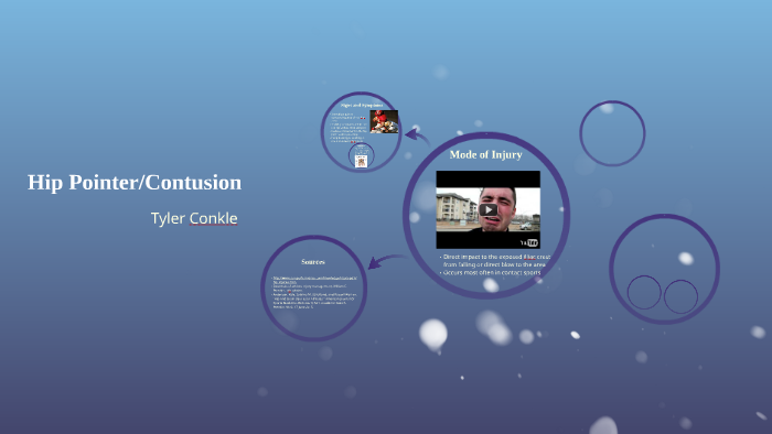Hip Pointer/Contusion by Tyler Conkle on Prezi