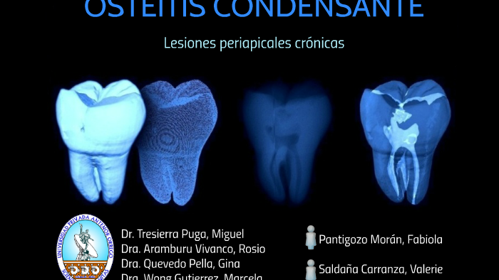 OSTEITIS CONDENSANTE by flucía pmorán on Prezi