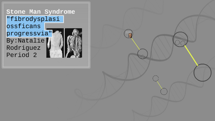 Stone Man Syndrome by Natalie Rodriguez on Prezi