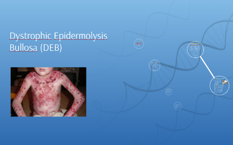 DEB ( Dystrophic Epidermolysis bullosa) by Meaghan Larabie on Prezi