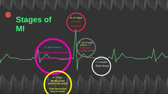 Stages of MI by Christian Acksteiner on Prezi