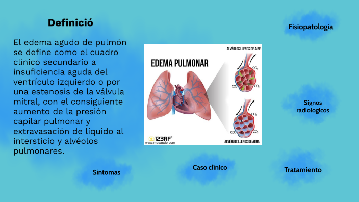 Edema Pulmonar Cardiogénico Rayos X