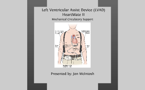 LVAD Presentation by Jonathon McIntosh on Prezi