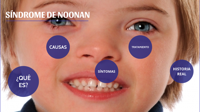 Sindrome De Noonan Adultos