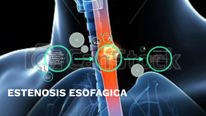 ESTENOSIS ESOFAGICA by Cristian Omar Mena Cedeño on Prezi