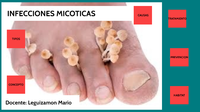 infecciones micoticas by mariolegui 77 on Prezi