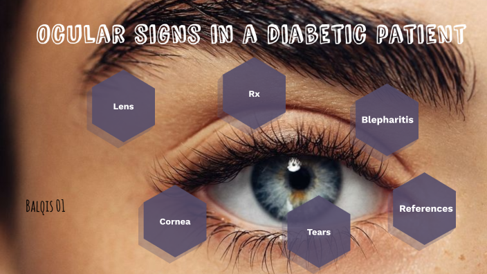 Ocular signs DM type 2 by Balqis Sulaiman on Prezi