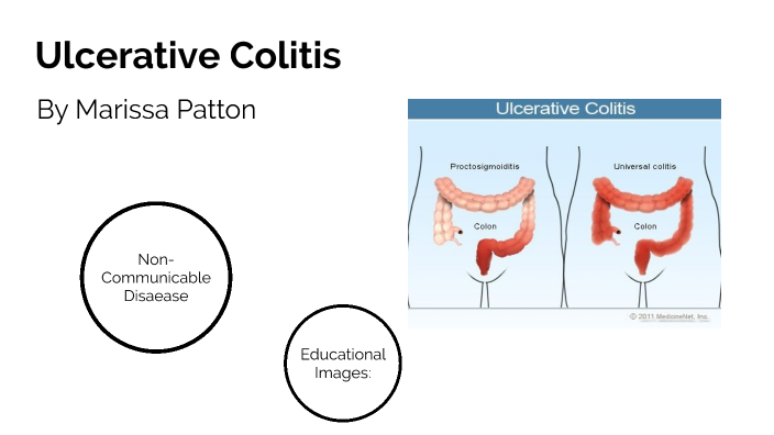 Colitis by Marissa Patton on Prezi