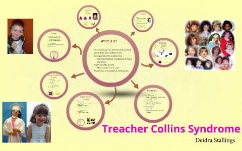 Treacher Collins Syndrome by Deidra Stallings on Prezi