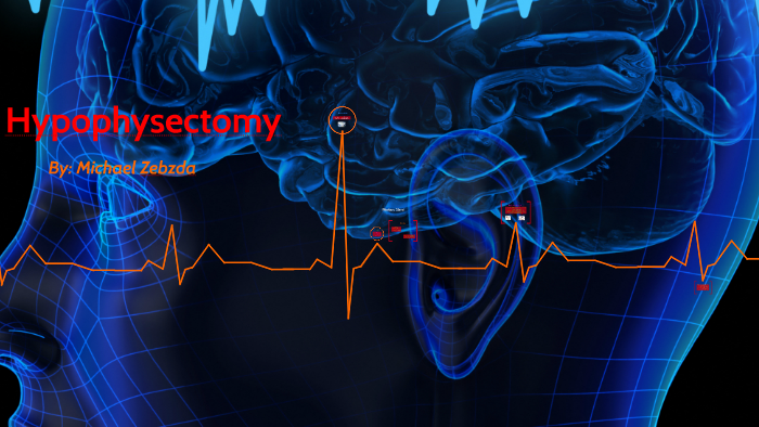 hypophysectomy by Dominique Coticchio on Prezi