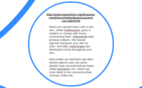 Moles are caused when cells in the skin, called melanocytes, by Jenna ...