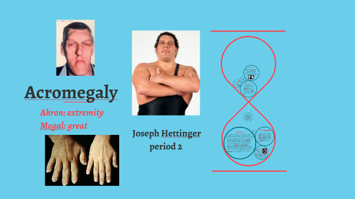 Acromegaly by Joseph Hettinger