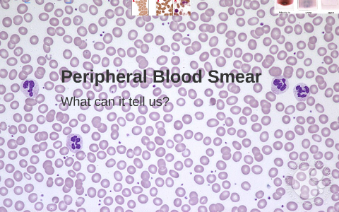 Peripheral blood smear by Ernest Wong on Prezi