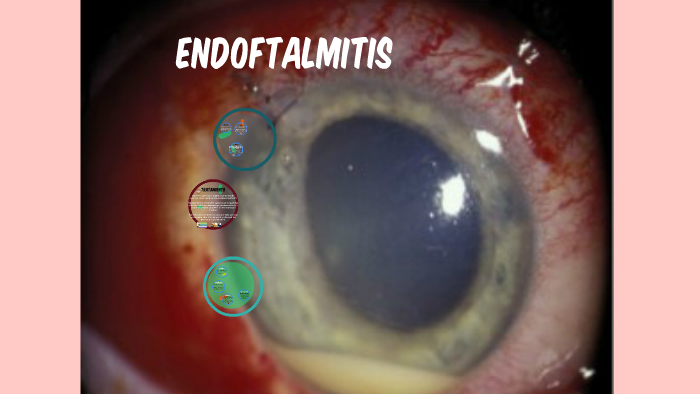ENDOFTALMITIS by Paola Delgado on Prezi