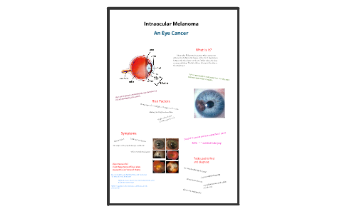 Intraocular Melanoma: Eye Cancer by Gabriela Gutierrez on Prezi
