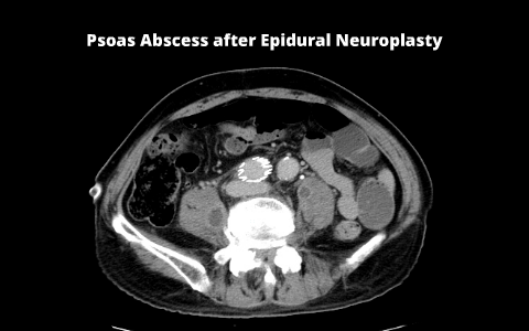 Psoas Abscess by Jeong Hun Suh on Prezi