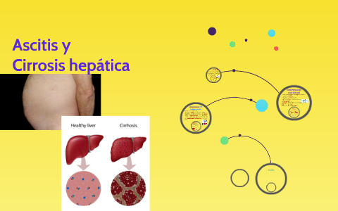 Ascitis y Cirrosis hepatica by on Prezi