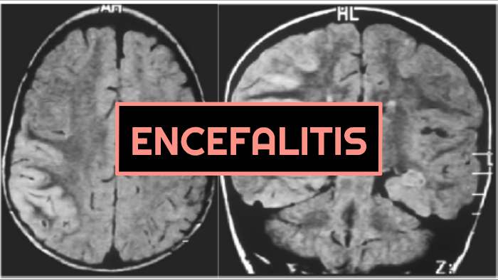 ENCEFALITIS by on Prezi