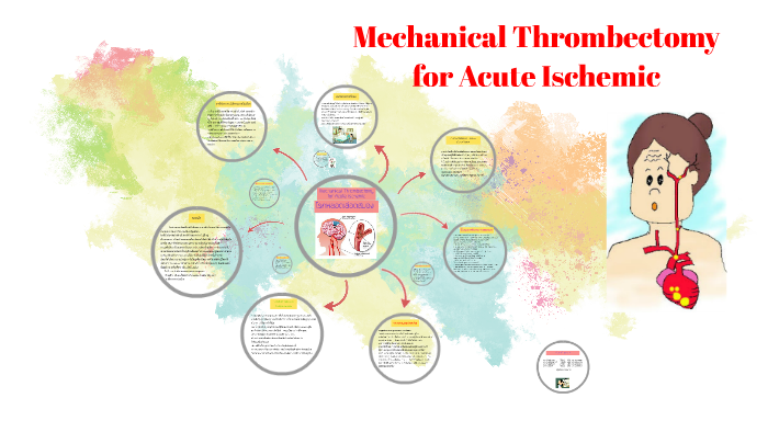 Mechanical Thrombectomy by Kanokthip Foithong