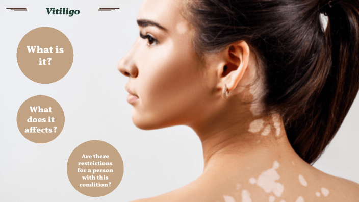 Integumentary System Disorders & Diseases Project by Brooklyn Bresko on ...