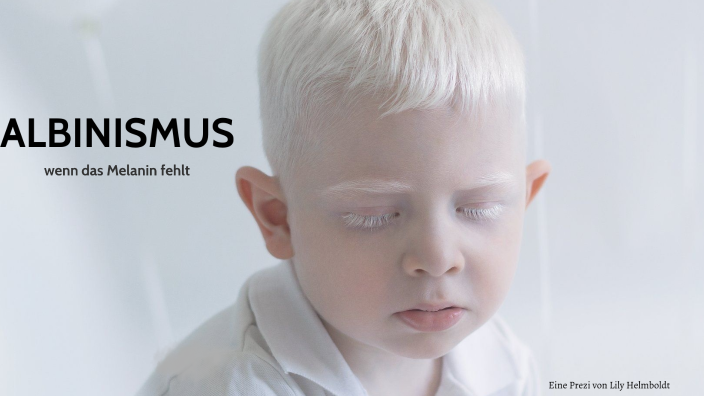 Arten Und Symptome Von Albinismus Albinismus Und Das Auge Augenarzt