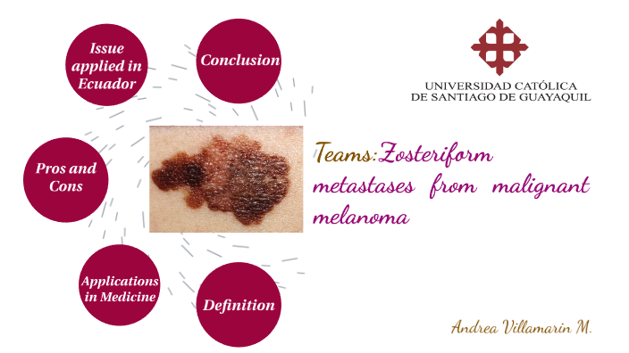 zosteriform metastases from malignant melanoma by Andrea Villamarin ...