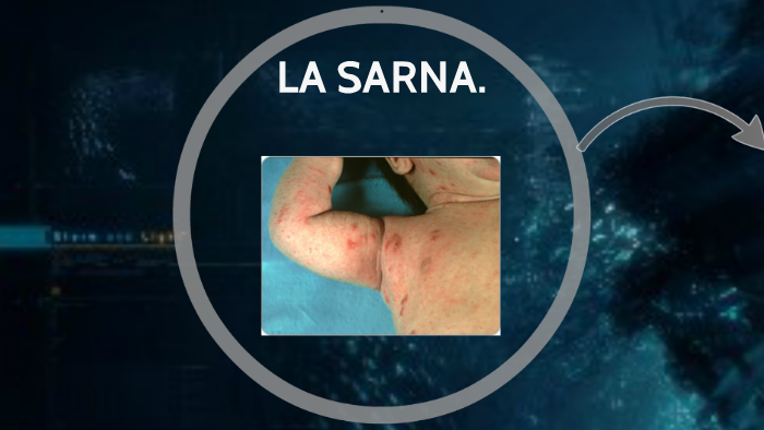 LA SARNA. by David Moros Velasco on Prezi