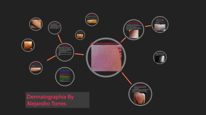 What does dermatographia look like? by Alejandro Torres on Prezi