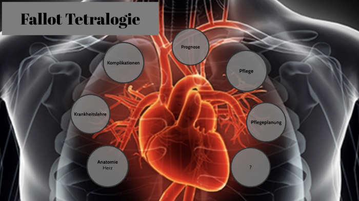 Fallot Tetralogie by Carolina Ramirez-Sanchez on Prezi