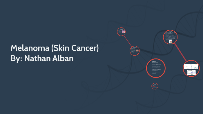 Melanoma by nathan alban