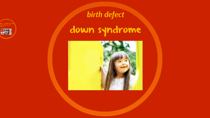 Down syndrome by lora ream on Prezi