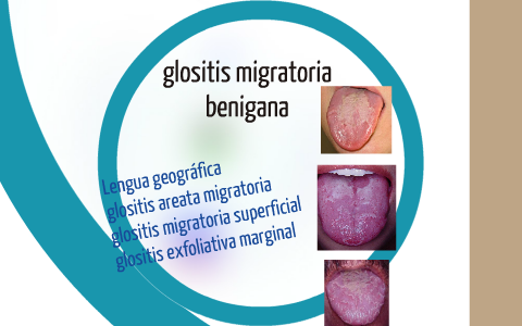 glositis migratoria benigna by romy sdfjdsfñdflds on Prezi