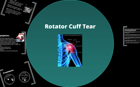 Rotator Cuff Tear by Tom Lee on Prezi