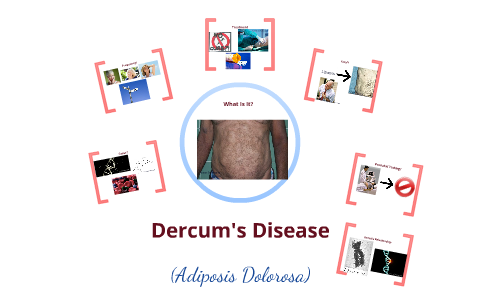 Dercum's Disease by Shahzad Khan on Prezi
