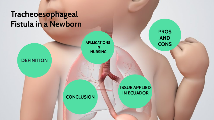Tracheoesophageal Fistula in a Newborn by jenny Yagloa on Prezi