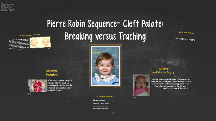 Pierre Robin Sequence- Cleft Palate: by Brianna LaZerte on Prezi