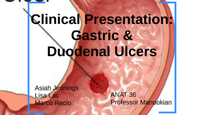 Gastric and Duodenal Ulcers by on Prezi