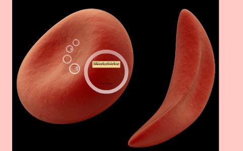 Sikkelcelziekte by Michiel Dubbelman on Prezi