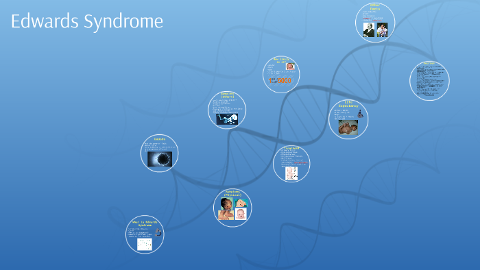 Edward's Syndrome/Trisomy 18 by L Rios on Prezi