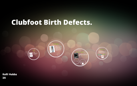 Clubfoot and Other Foot Birth Defects. by Kelli H on Prezi