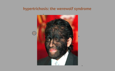 hypertrichosis: the werewolf disease by josiah breen on Prezi