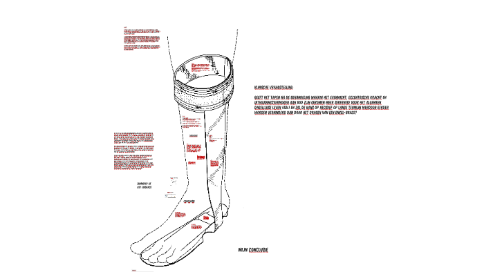 Vergelijking van de resultaten van de behandeling met enkel-brace en ...