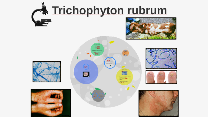 Trichophyton Rubrum by Kaitlyn Tavakoli on Prezi