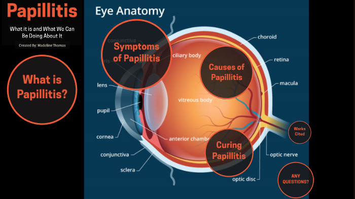 Papillitis by Madeline Thomas on Prezi