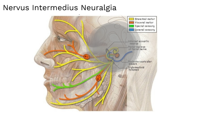 Nervus Intermedius Neuralgia by Julia Rodes on Prezi